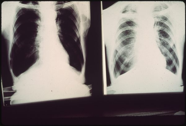 Black Lung Disease is Making a Come-Back - The Plainspoken Scientist ...